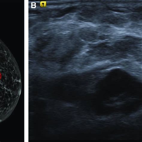 PDF Lymph Node Imaging In Patients With Primary Breast Cancer Concurrent Diagnostic Tools