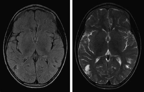 Focal Cortical Defect Axial Flair Tr 2200 Te Min Full And Fov 25 Download Scientific