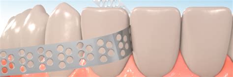 What Is Interproximal Reduction Ipr [with Video]