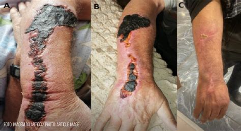 Case Of Severe Bullous Cutaneous Anthrax Case Sbmt