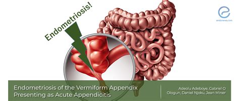 Endometriosis Of The Appendix Endonews