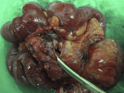 Surgical Specimen Revealing A Small Bowel Tight Adhesion With Download Scientific Diagram