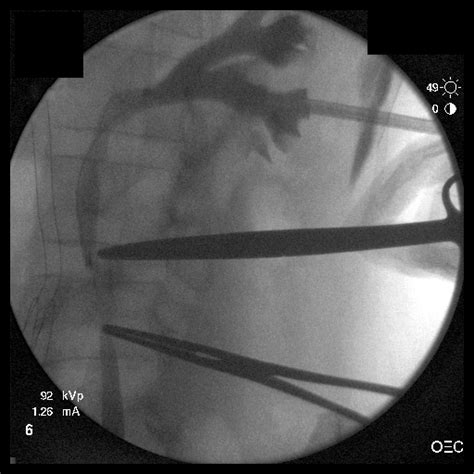 Antegrade Pyelogram Showing Mid Proximal Ureteral Stricture Download
