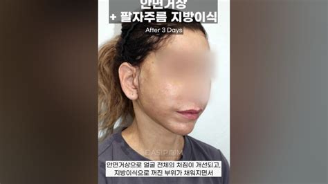 다시피움 안면거상 팔자주름 지방이식 네이버 Tv