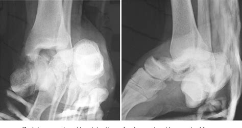 Table 1 From Open Talar Dislocations Without Associated Fractures Semantic Scholar