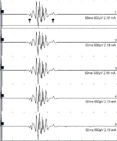 1 Invasive Muscle Fiber Conduction Velocity Measurement Example