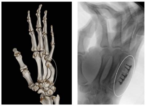 Fratura Do Metacarpo Quais São Suas Causas E Tratamentos