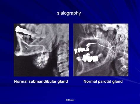 Common Syndromes Affecting The Head And Neck Ppt
