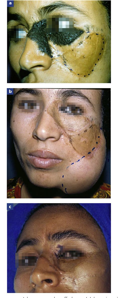 Set Of Anterior Jugulo Omohyoid Lymph Nodes Semantic Scholar