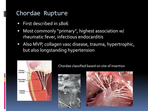 Ppt Chordae Tendineae Rupture Powerpoint Presentation Free Download