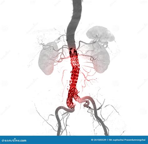 Cta Whole Aorta With Abdominal Aorta Stent Graft Compare 3d Rendering Image Royalty Free Stock