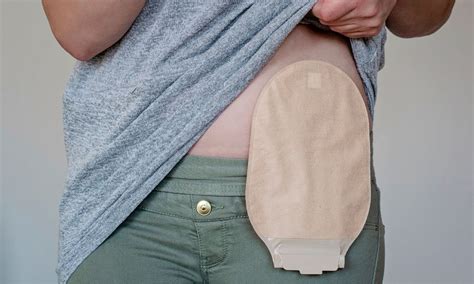 Best Practices For Living With An Ostomy Bag My Care Supplies