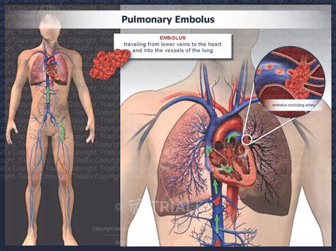 Pulmonary Embolus Trialquest Inc