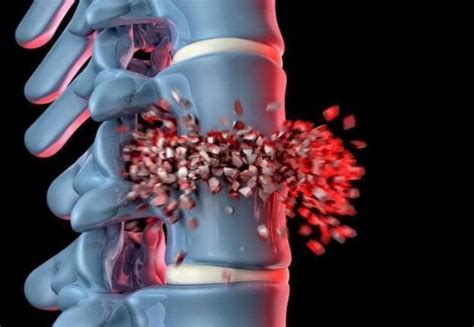 前列腺癌发生骨转移怎么办？ 知乎