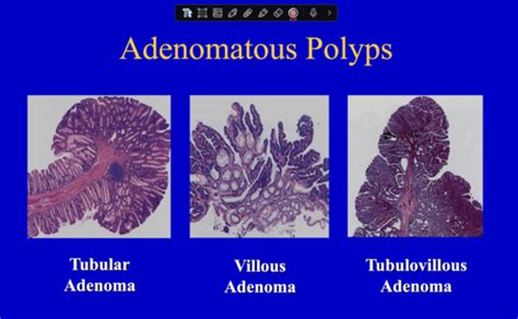 Colon Polyps Colorectal Cancer Flashcards Quizlet