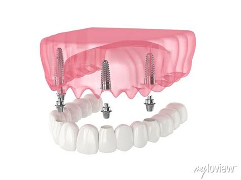 Mandibular Prosthesis All On 4 System Supported By Implants Posters For The Wall • Posters