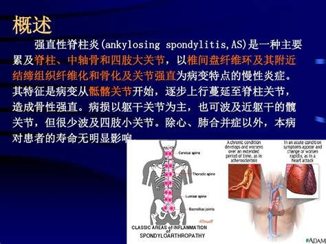 强直性脊柱炎word文档在线阅读与下载免费文档