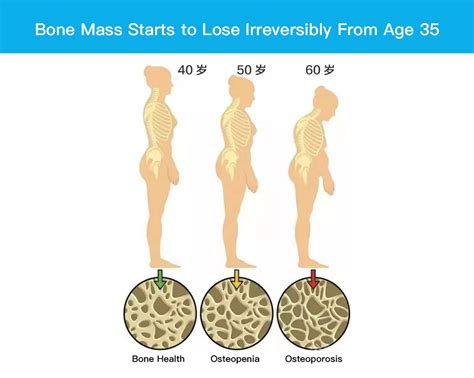 China 2022 New Style Dexa Bone Density Axial Test Portable Ultrasound Bone Densitometry Bmd A1