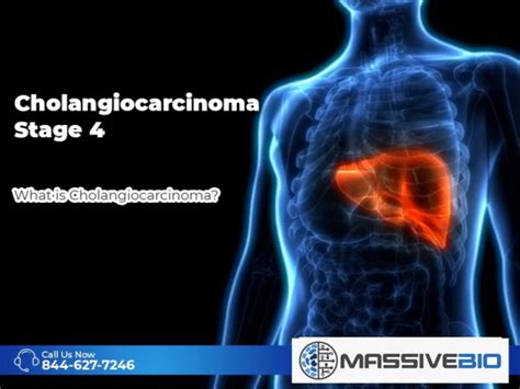 Cholangiocarcinoma Stage 4 Metastatic Cholangiocarcinoma
