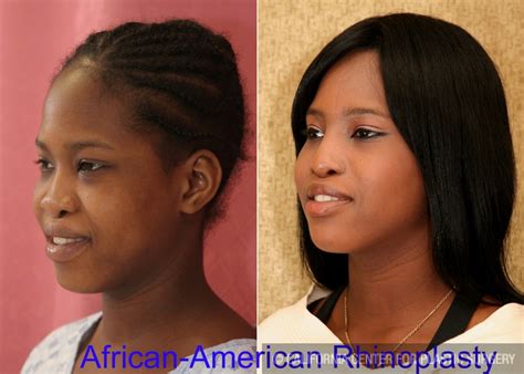 Nose Job Before And After African American