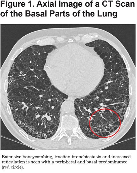 Copd Ct Scan Findings