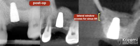Dental Implant Replacement With Sinus Lift Bone Graft Of A Non Restorable Tooth With Bone Loss