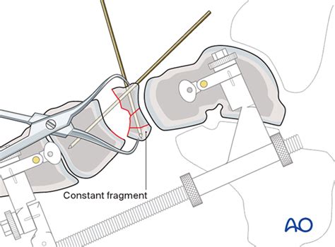 Fusion Of Unreconstructable Naviculocuneiform Joint