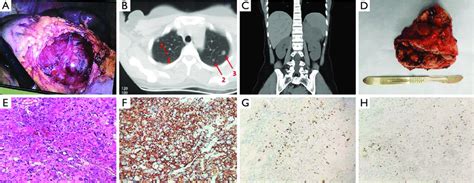 Laparoscopic Mass Image Pictures Gross Specimen And Pathologic