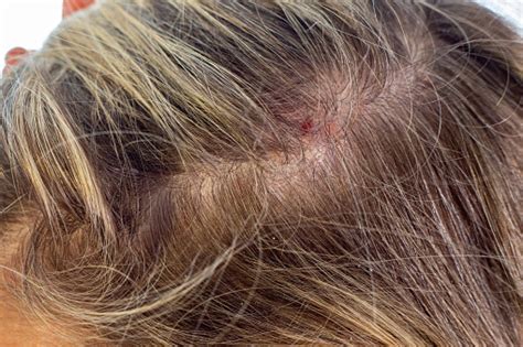 Psoriasis Of The Scalp Psoriatic Redness Peeling And Crusts On The Scalp Of An Unrecognizable