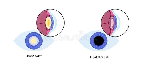 Intraocular Lenses Poster Stock Vector Illustration Of Posterior 327678311