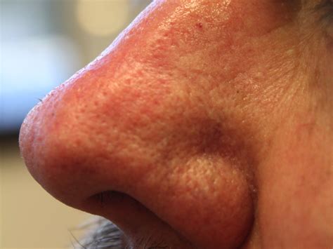 Mild Rhinophyma