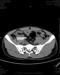 Acute Appendicitis Associated With Ct Intraluminal Hyperattenuation