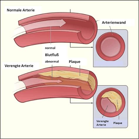 Atherosklerose Eine Autoimmunerkrankung Auslöser Und Gegenstrategien