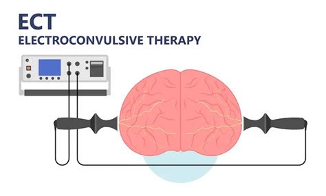 What Is The Full Form Of Ect