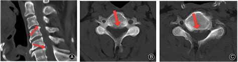 Anterior Full‐endoscopic Single‐port Double Transcorporeal Spinal Cord Decompression For