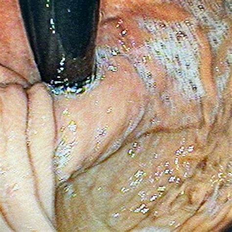 Diagnosis Of Hiatal Hernia By Endoscopy At Joseph Becher Blog