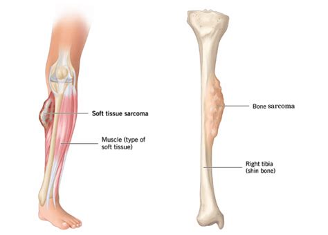 Surveillance Strategies For Resection Of Bone And Soft Tissue Sarcomas