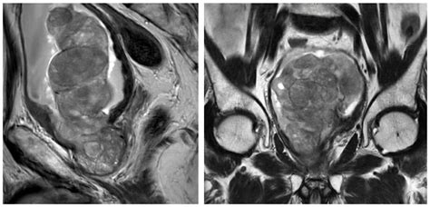 Intravesical Protrusion Of Giant Median Prostatic Lobe A Case Report Semantic Scholar