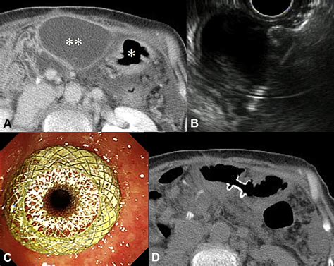 Afferent Loop Syndrome Radiology Notes