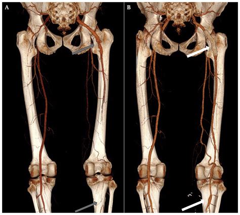 Endovascular Repair Of A Complicated Persistent Sciatic Artery Aneurysm