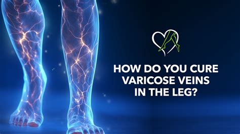 Learn About Varicose Veins And Treatments Center For Vein Restoration