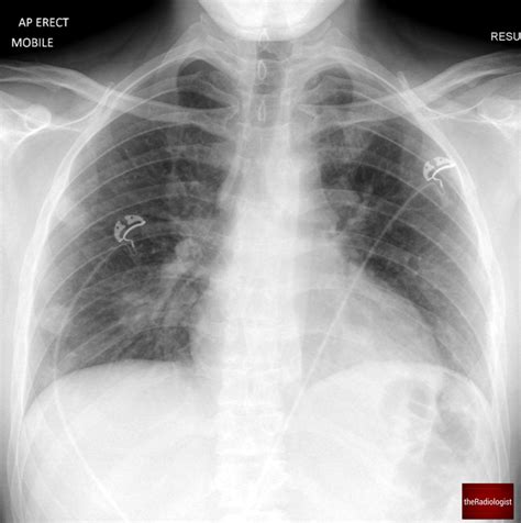 Assessing Septic Emboli The Radiologist