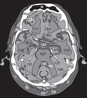 Cranial CT Normal Findings Radiology Key