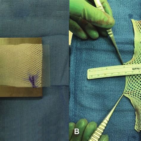 Meshed Acellular Dermal Matrix Adm Used In Breast Reconstruction A Download Scientific