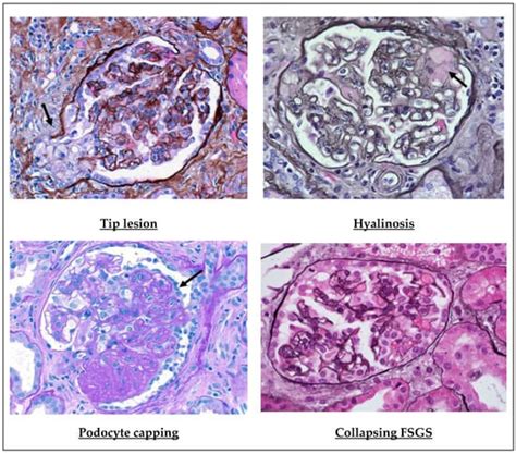 Sclerosis An Open Access Journal From Mdpi