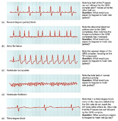 Cardiac Arrhythmia Symptoms And Treatment