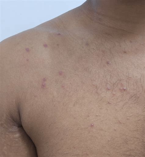 Acute Hiv Symptoms Rhiv