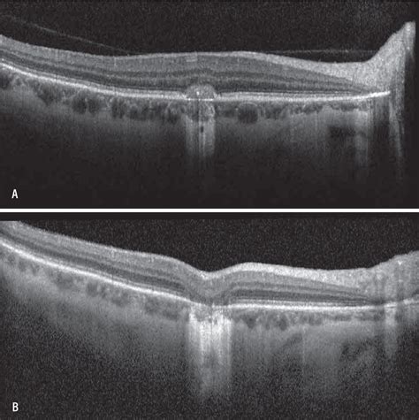 Managing Inflammatory Cnvm In Uveitis