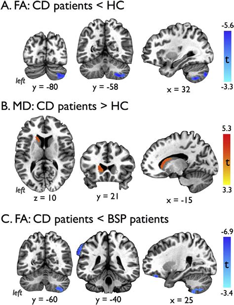 Results Of Voxel Based Analyses Showing A Cluster Of Reduced