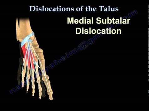 Tibiotalar Joint Dislocation